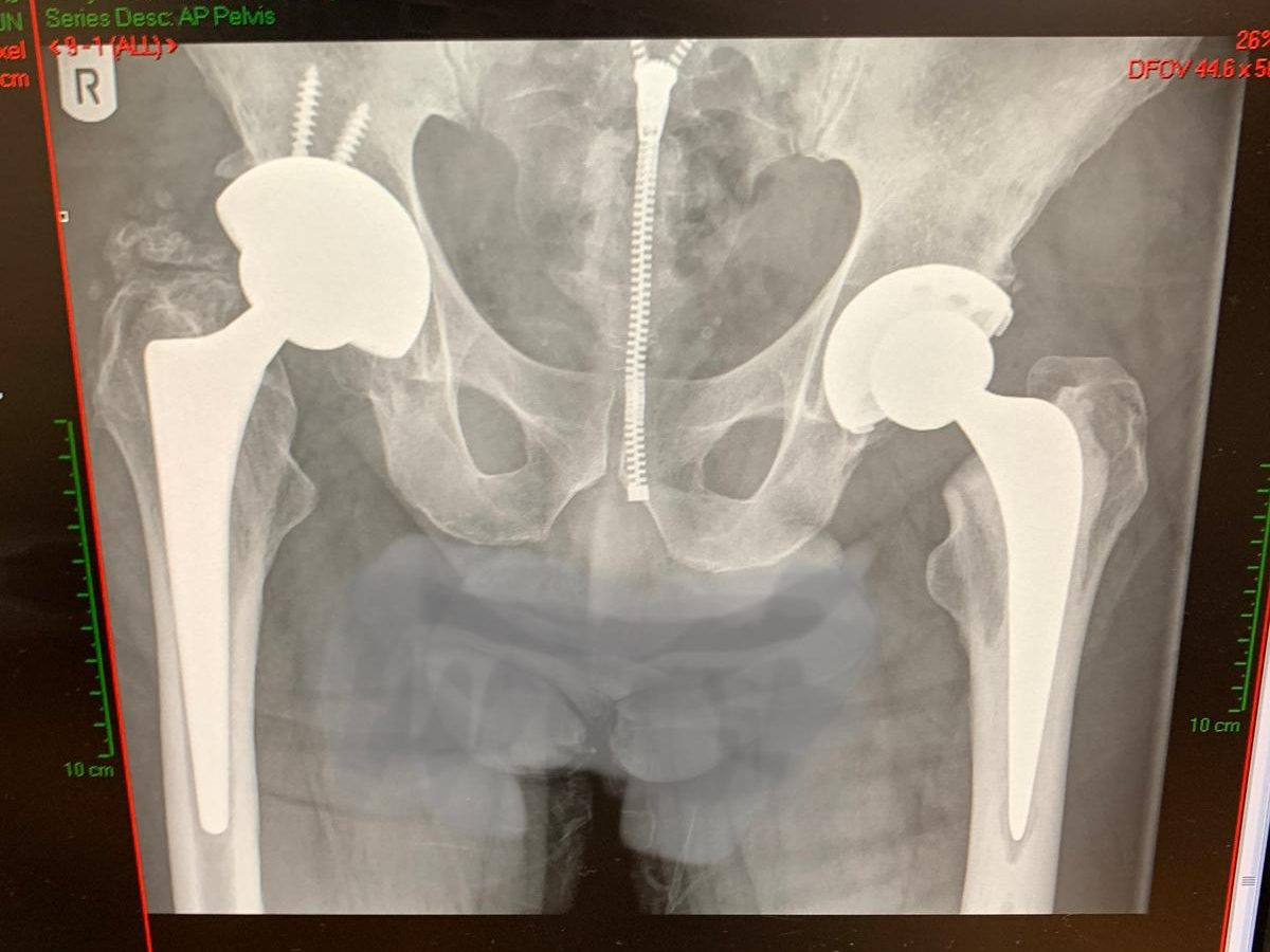 Success Story: Paul Jones – Recovery from hip replacement – ATP ...